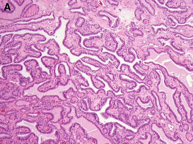 Thyroid Adenoma Histology
