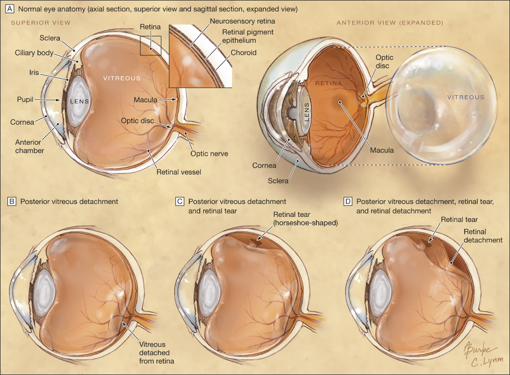 Posterior Vitreous Detachment Floaters