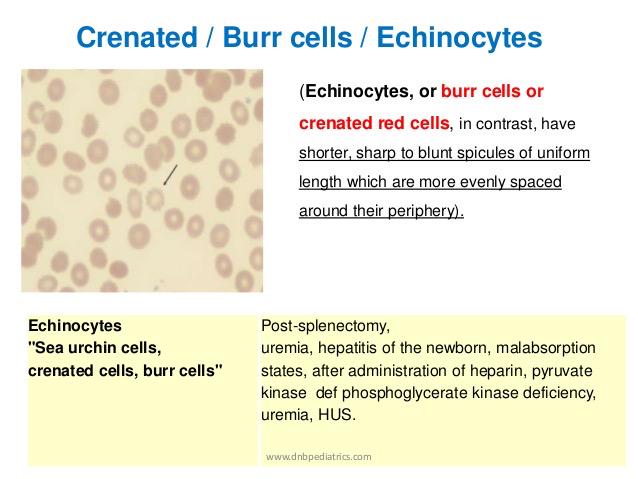 Echinocytes And Crenation