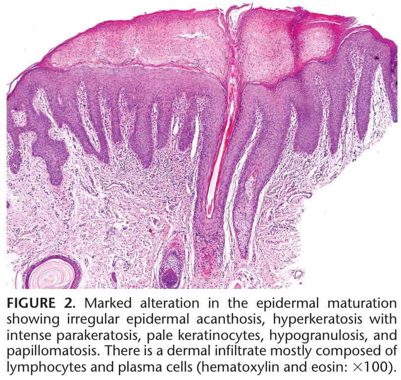 Acanthosis Histology