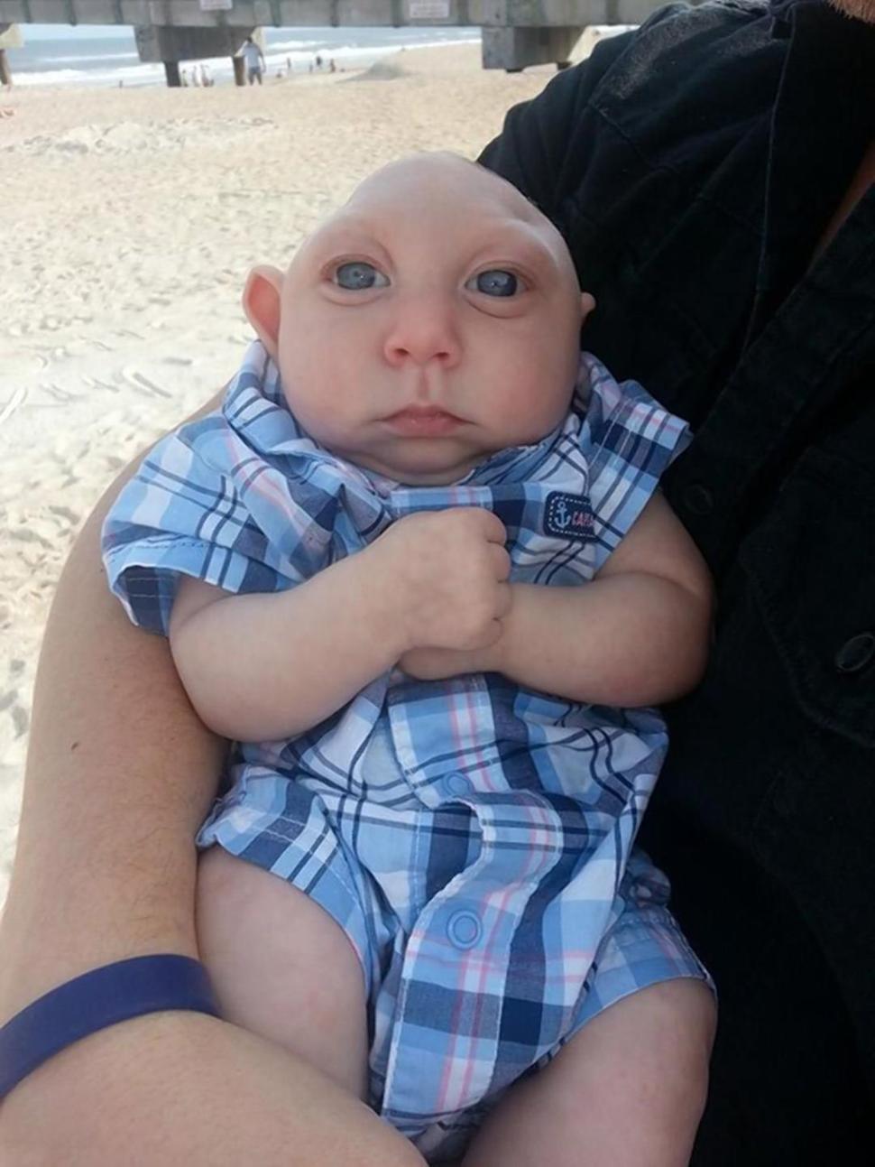 Baby Born Without A Skull