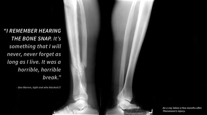 Joe Theismann Broken Leg X Ray
