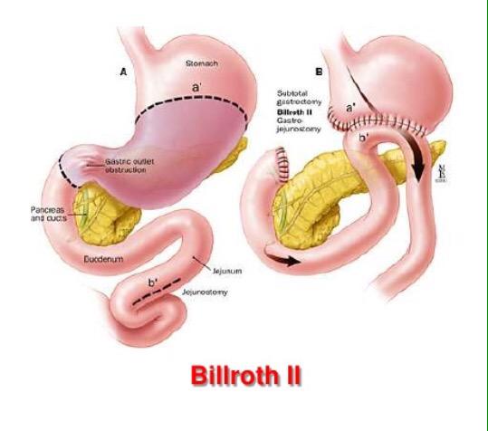 The Gallery For Gt Billroth Ii Whipple Atlas Of Endoscopy Imaging In