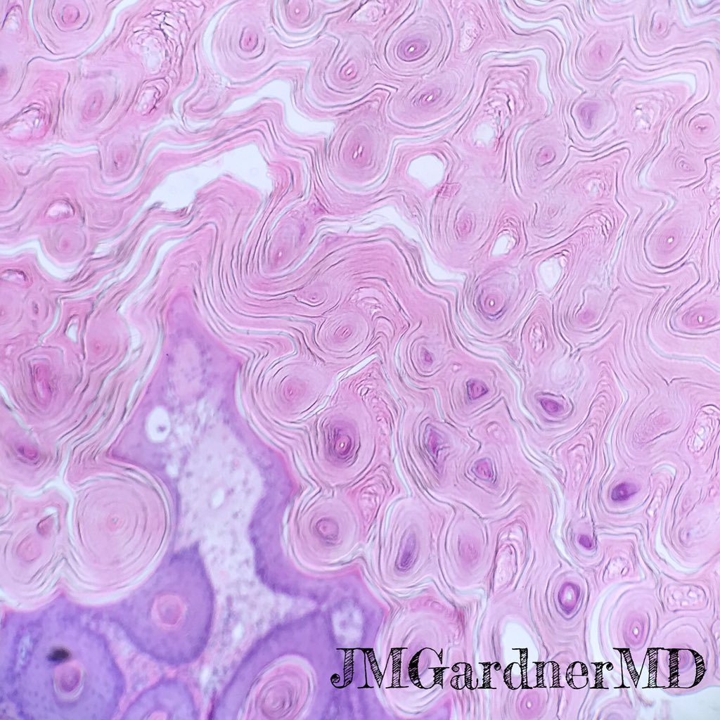 Lamellar Ichthyosis Histology