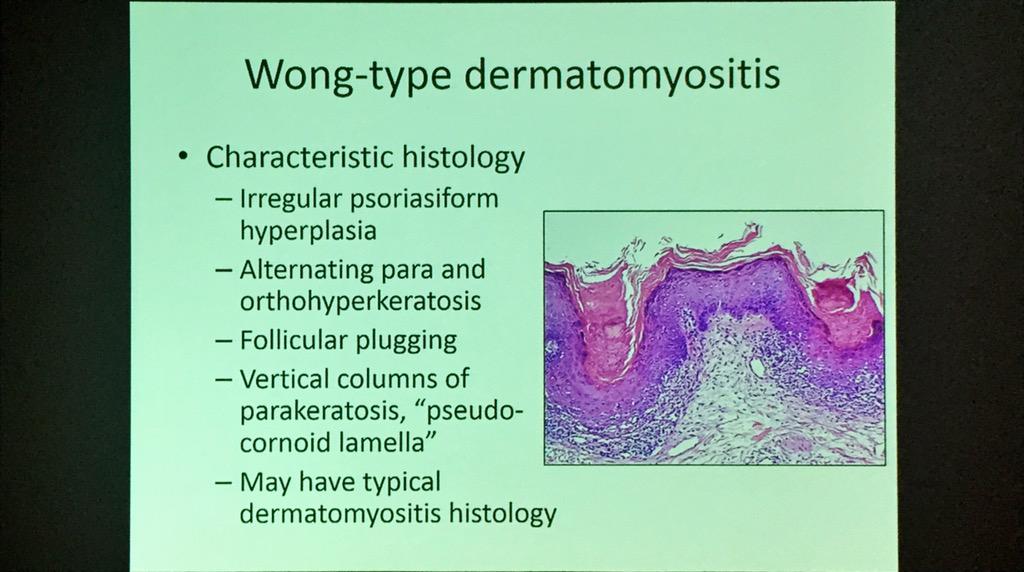 Dermatomyositis Histology