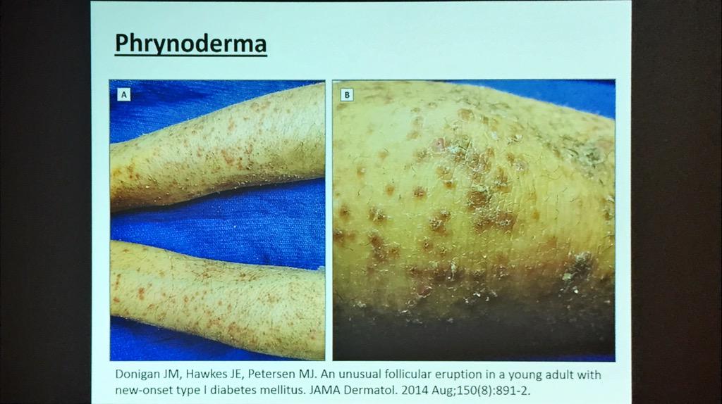 Phrynoderma