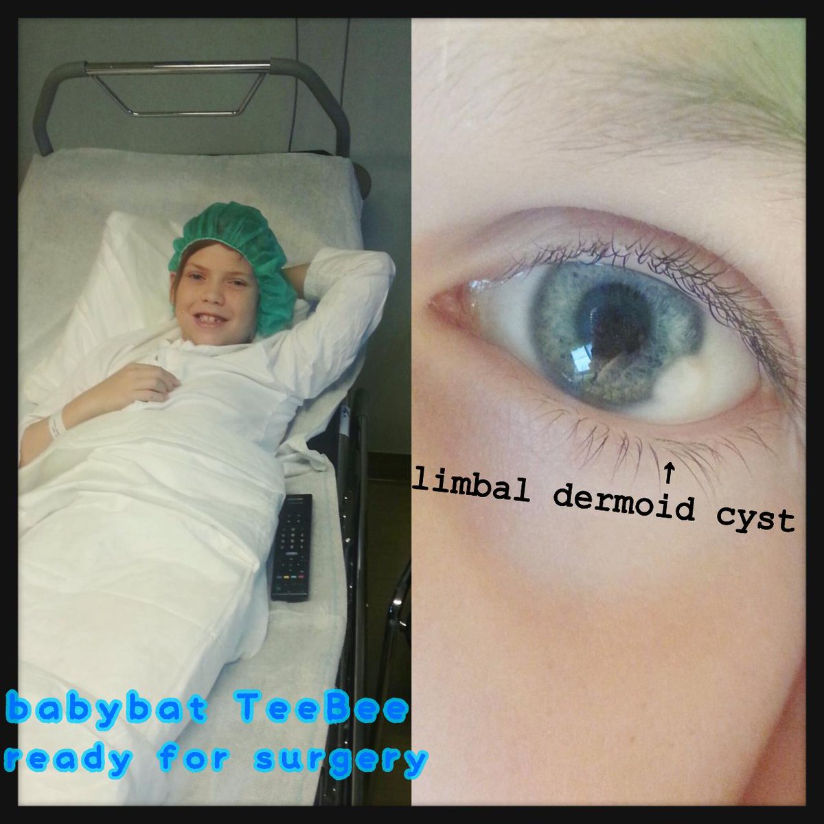 Limbal Dermoid Cyst Eye