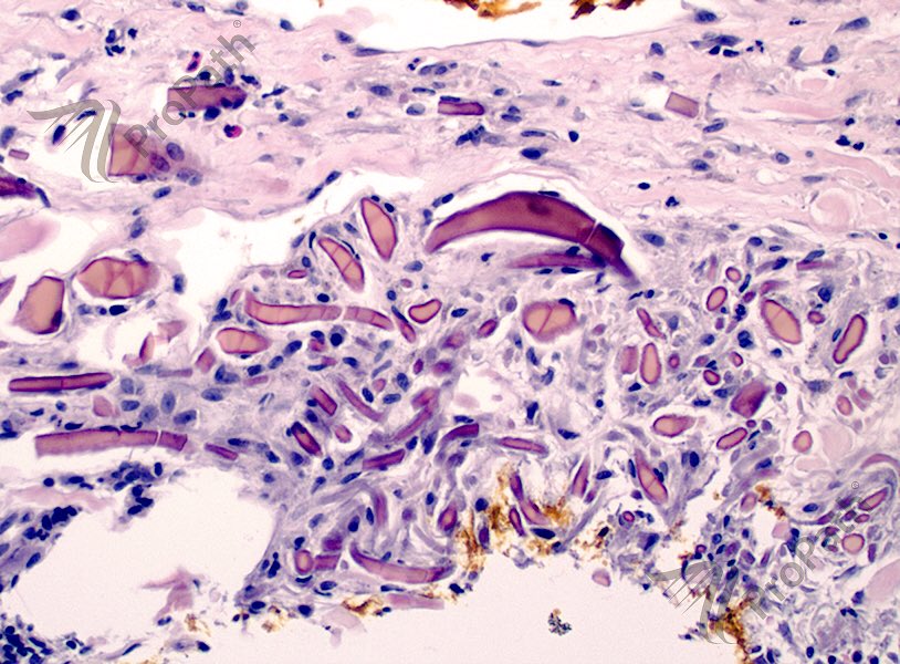 Ochronosis Histology