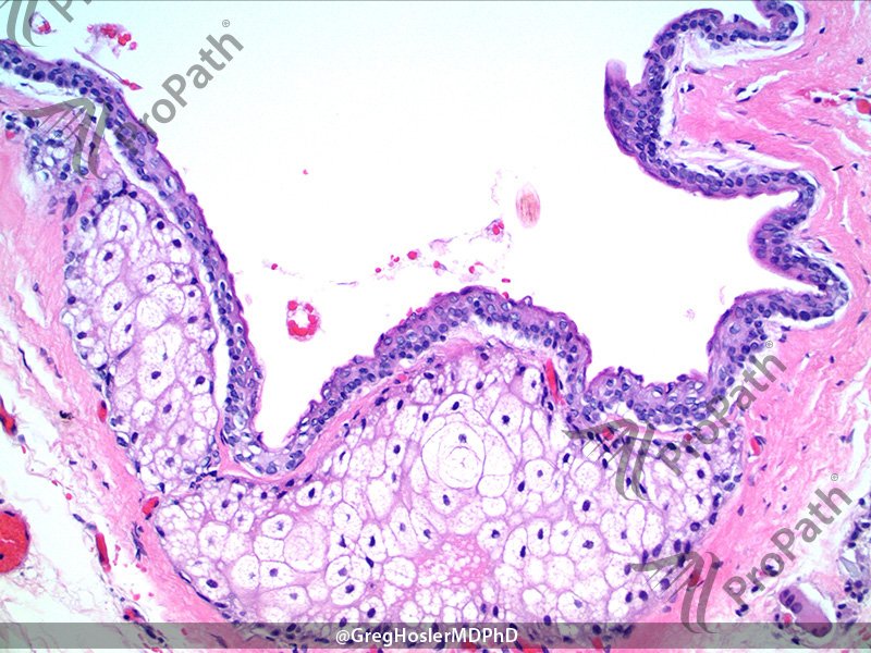 Steatocystoma Multiplex Histology