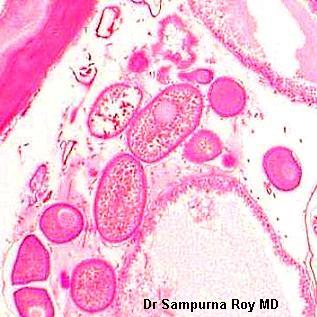 Tunga Penetrans Histology