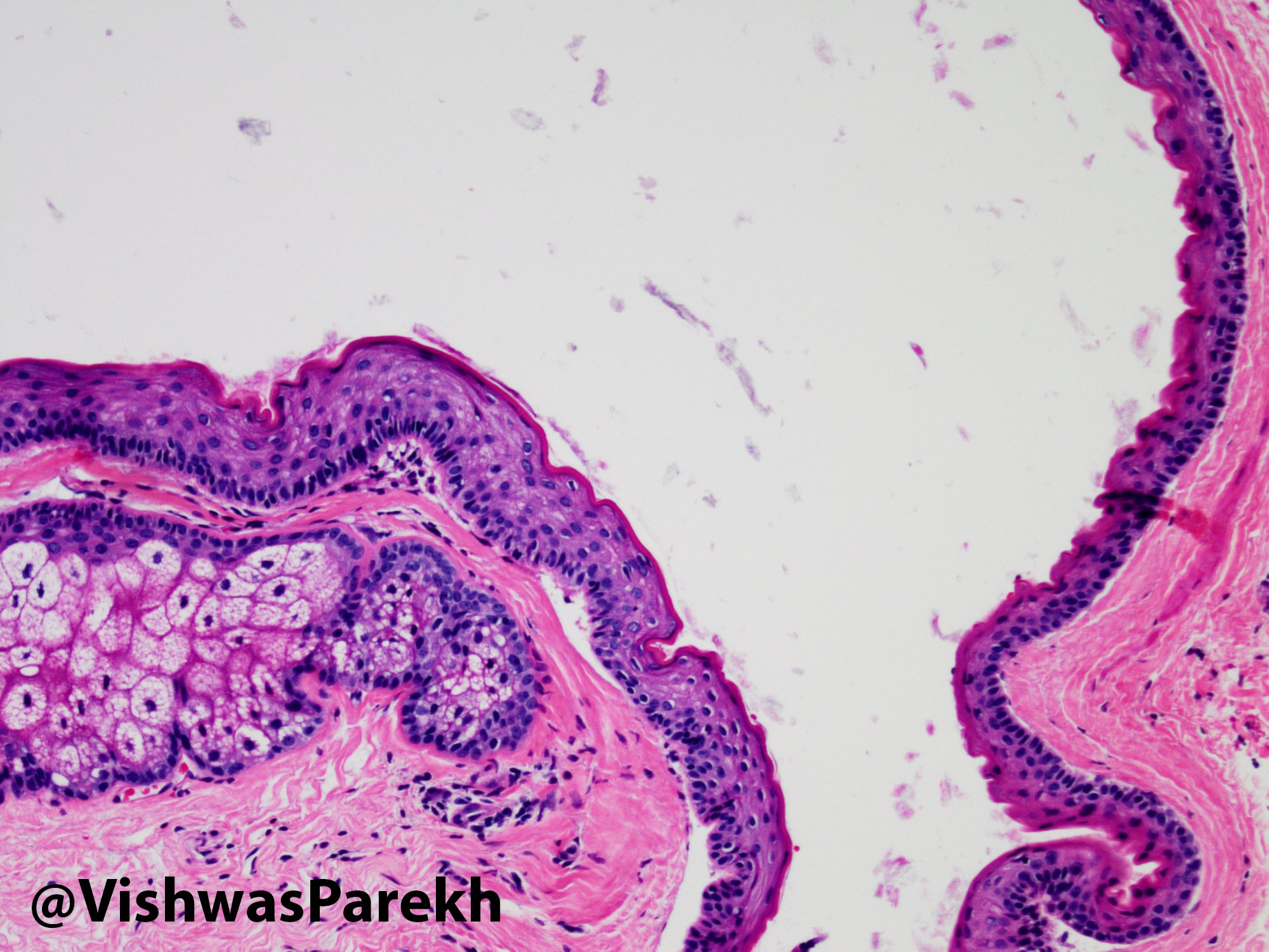 Steatocystoma Multiplex Histology