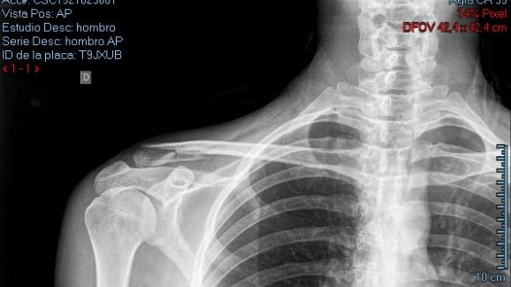 siguiente radiografía de control, a los 11 días. ¿Cómo lo ve? Por ...