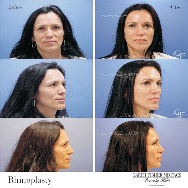 Garth Fisher Before And After