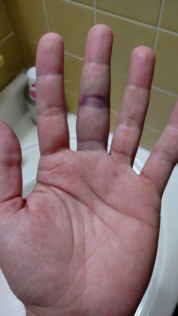 Smashed Middle Finger