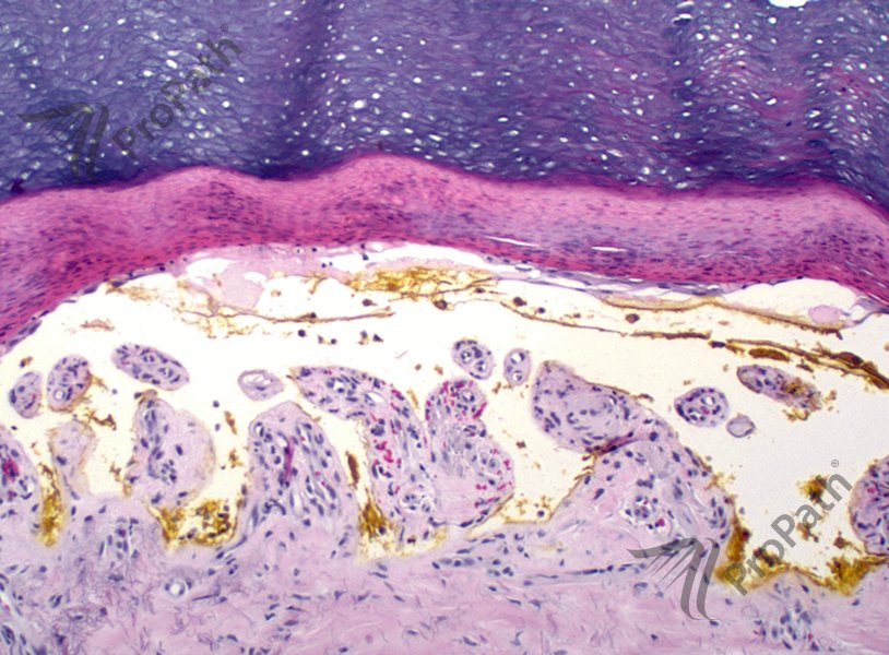Porphyria Cutanea Tarda Histology