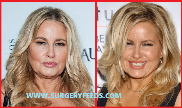 Jennifer Coolidge Plastic Surgery Before And After Bra