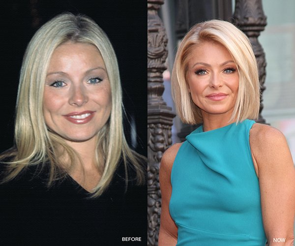 Kelly Ripa Before And After Botox
