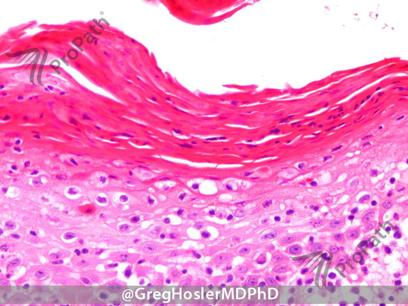 Acrodermatitis Enteropathica Histology