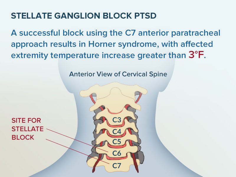 Stellate ganglion block