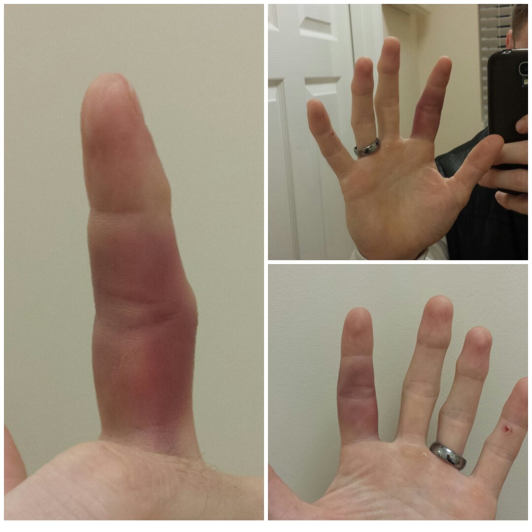 Bruised Middle Finger