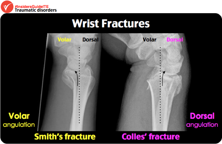 Smith Vs Colles Fracture