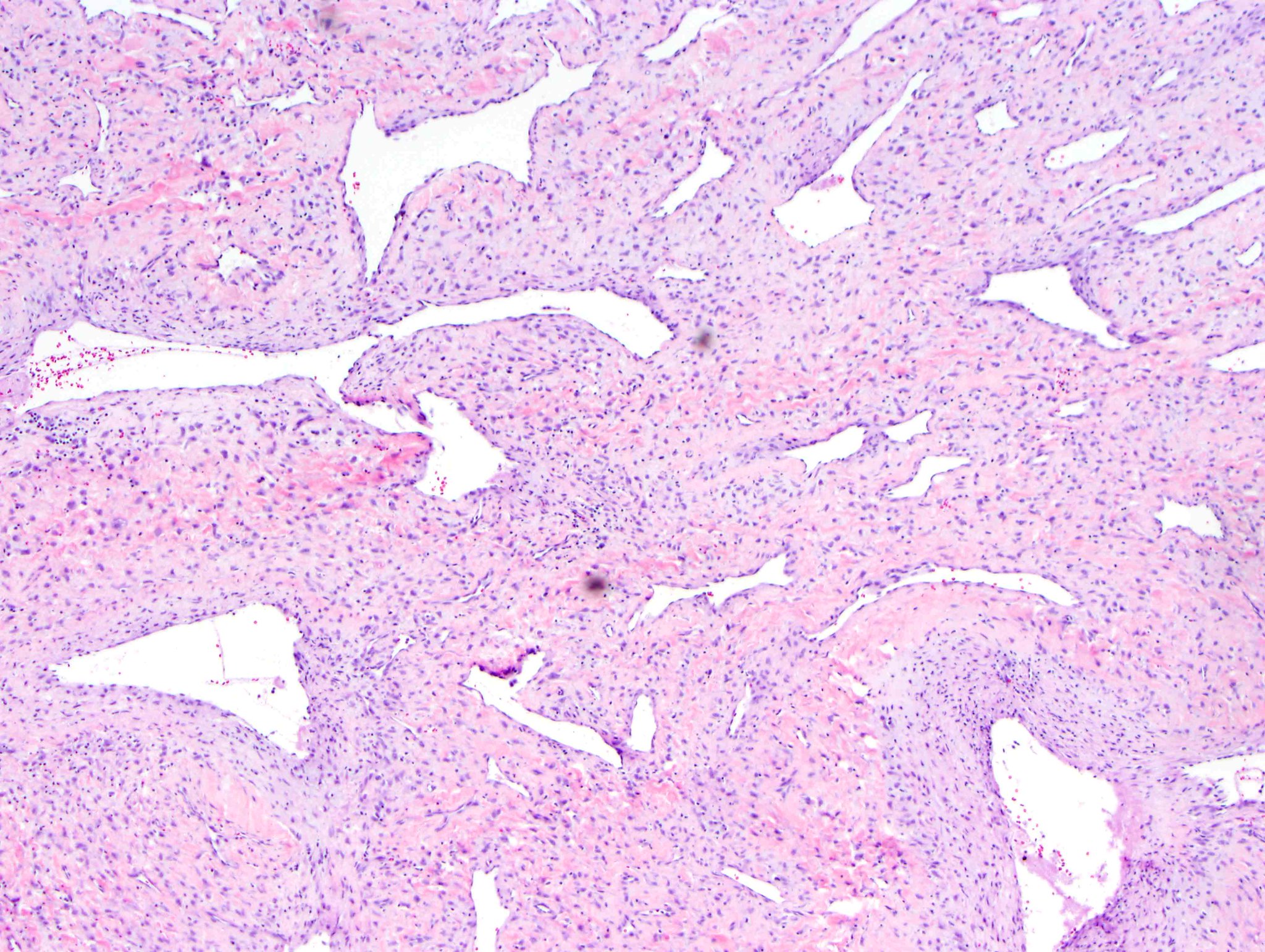 Nasopharyngeal Angiofibroma Histology
