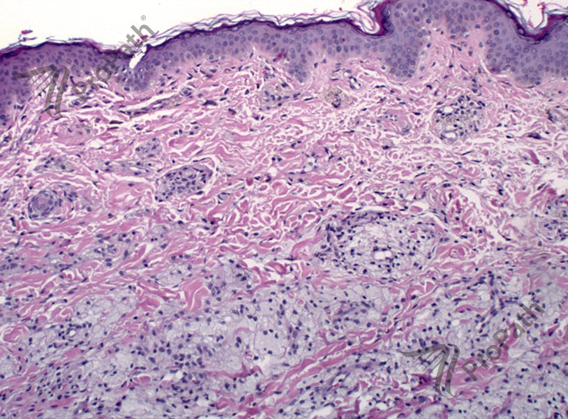 Xanthelasma Histology