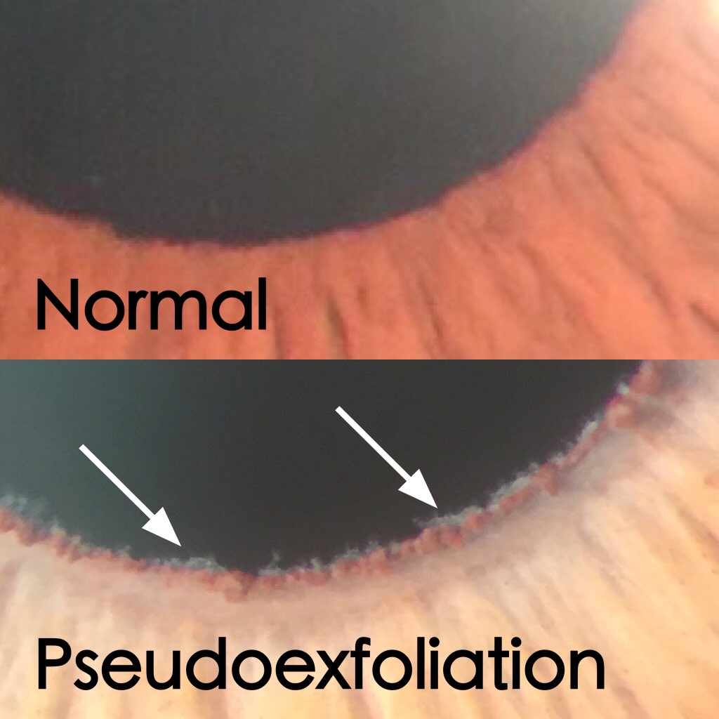 Pseudoexfoliation