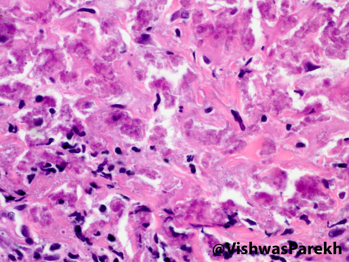Pseudoxanthoma Elasticum Histology