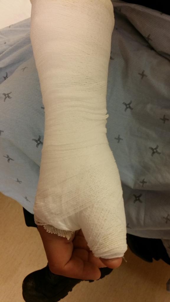 Thumb Spica Splint Plaster