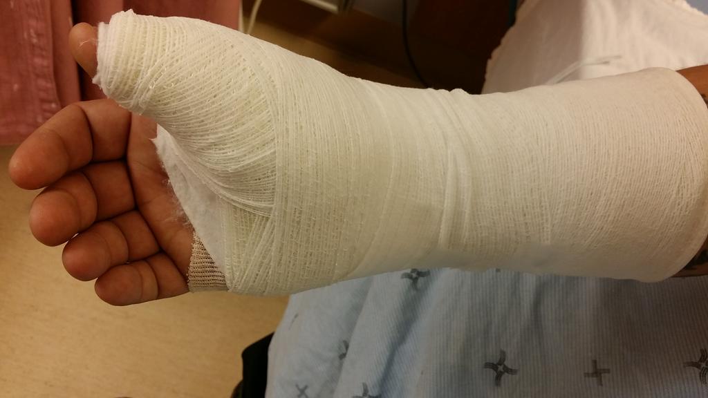 Thumb Spica Splint Plaster