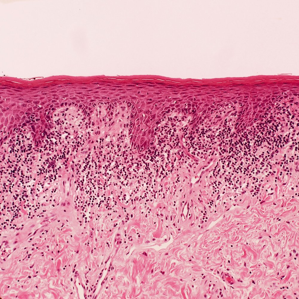 Lichen Planus Histology Sawtooth R J M E