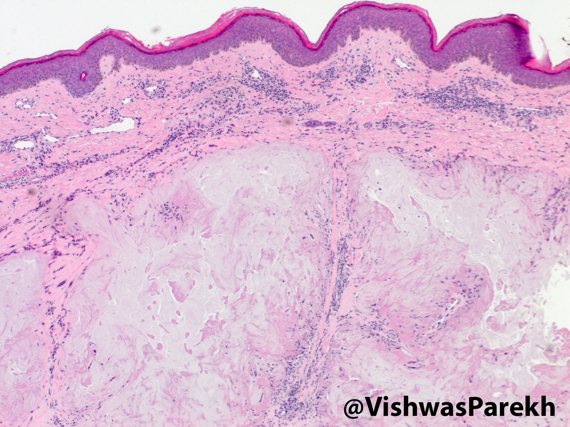 Tophus Histology