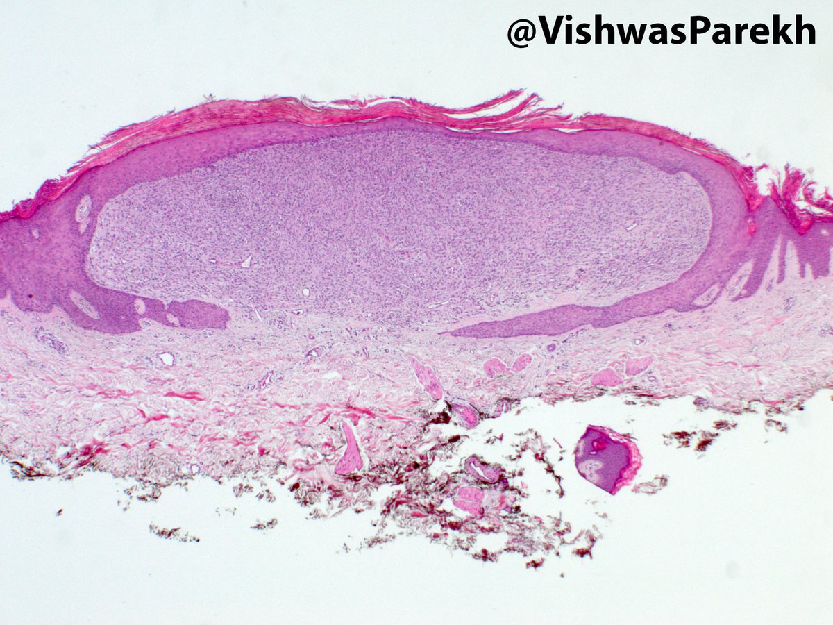 Dermatofibroma Histology