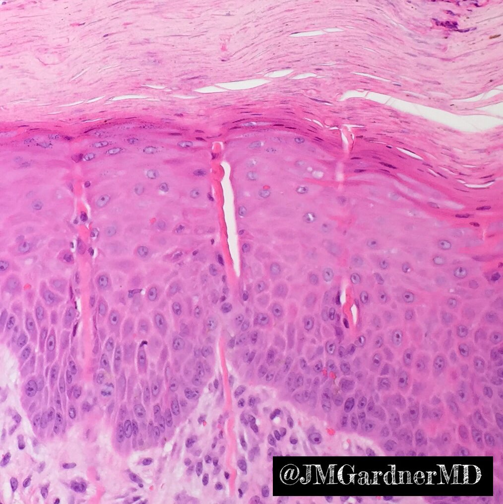Reactive Perforating Collagenosis