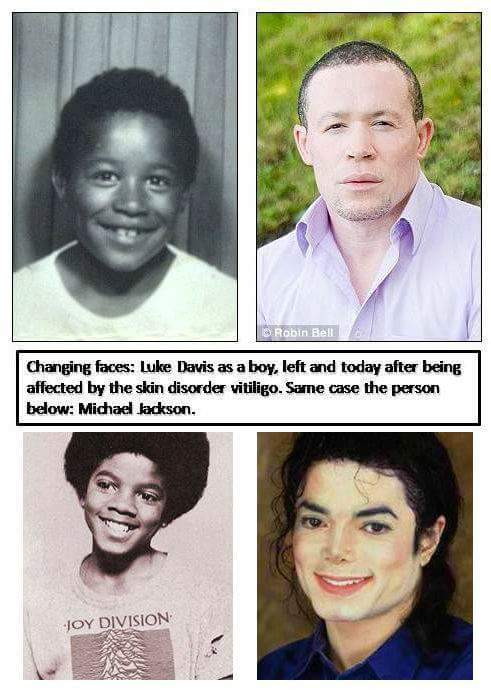 Michael Jackson Vitiligo Before And After