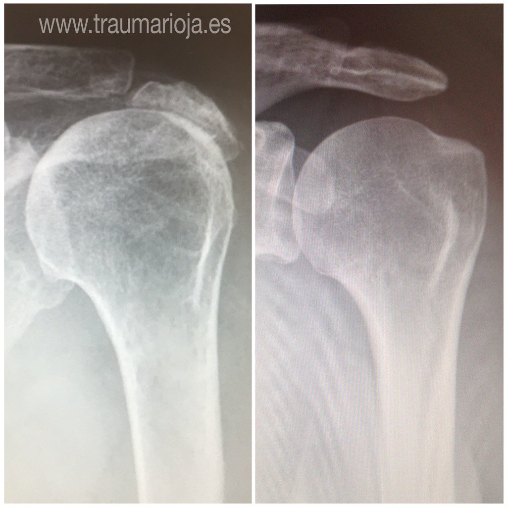 Bloc d´un Metge de Família: Ascens del cap humeral per trencament ...