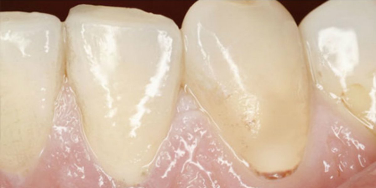 Pale Gums