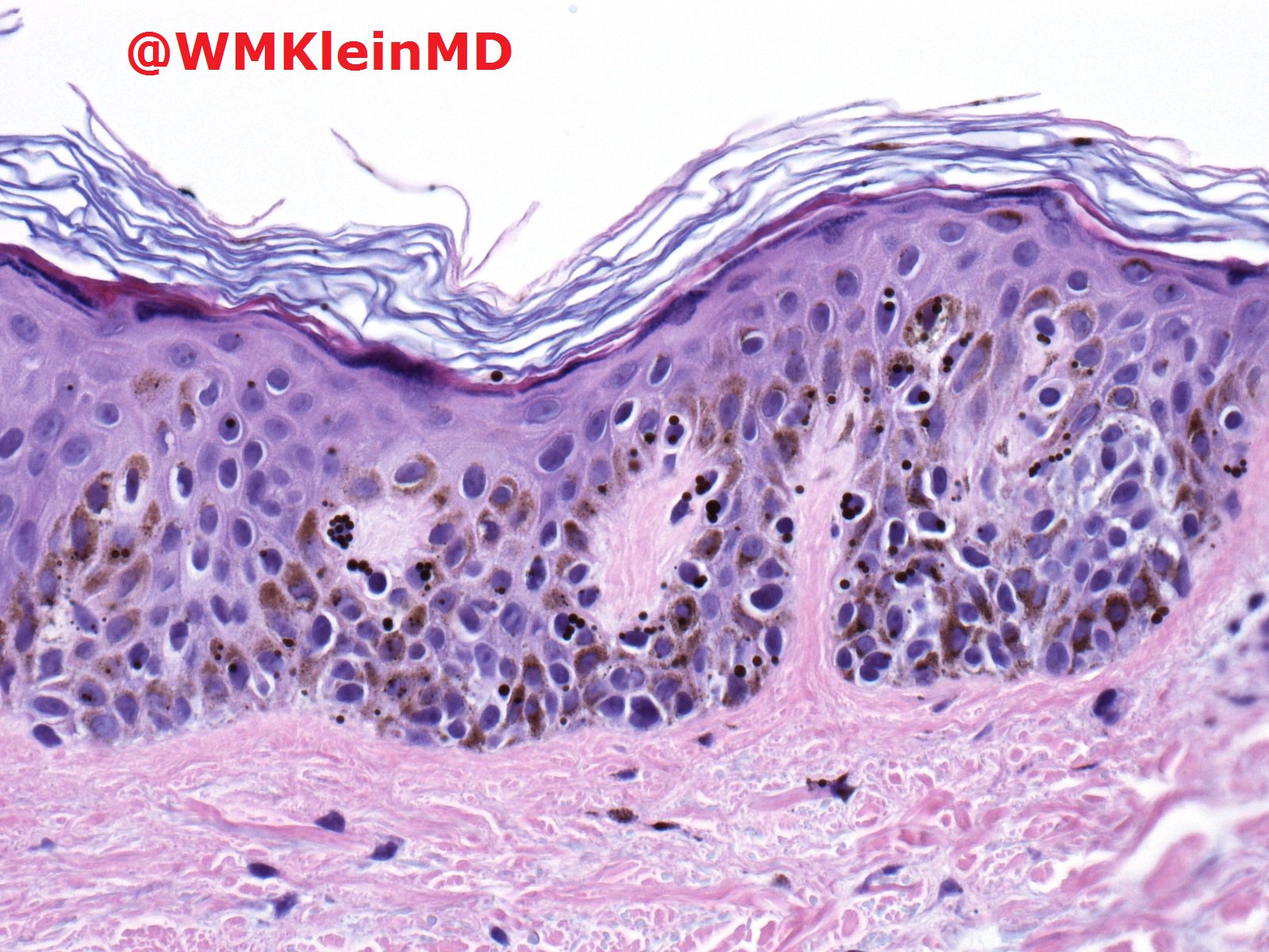 Junctional Nevus Histology