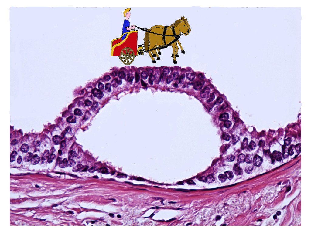 Roman Bridges Breast Pathology