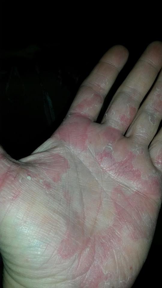 Psoriasis Palms Of Hands