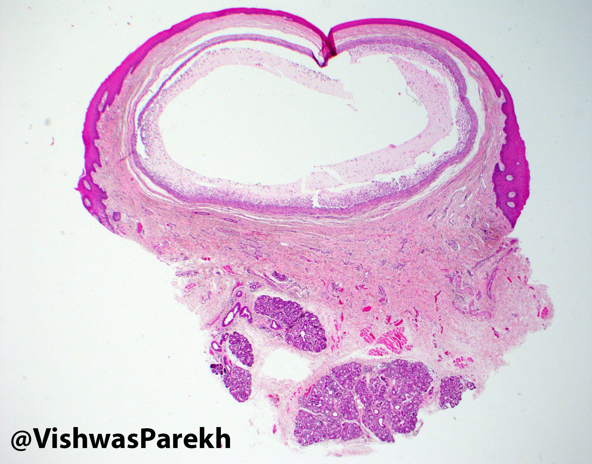 Mucocele Histology
