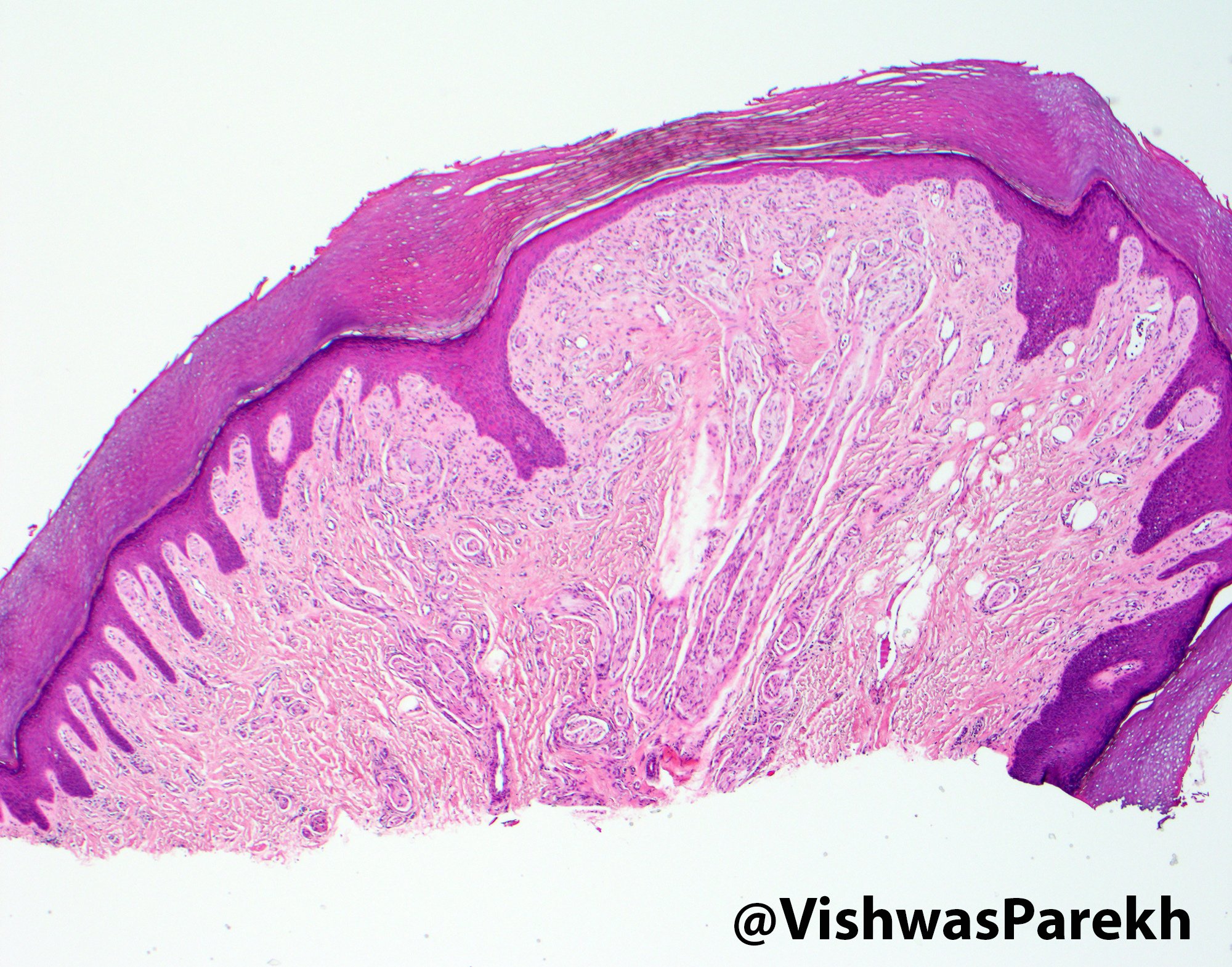 Traumatic Neuroma Histopathology