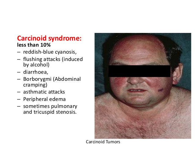 Carcinoid Syndrome