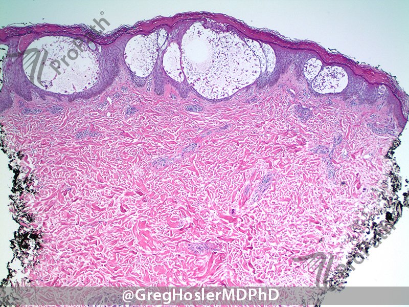 Allergic Contact Dermatitis Histology