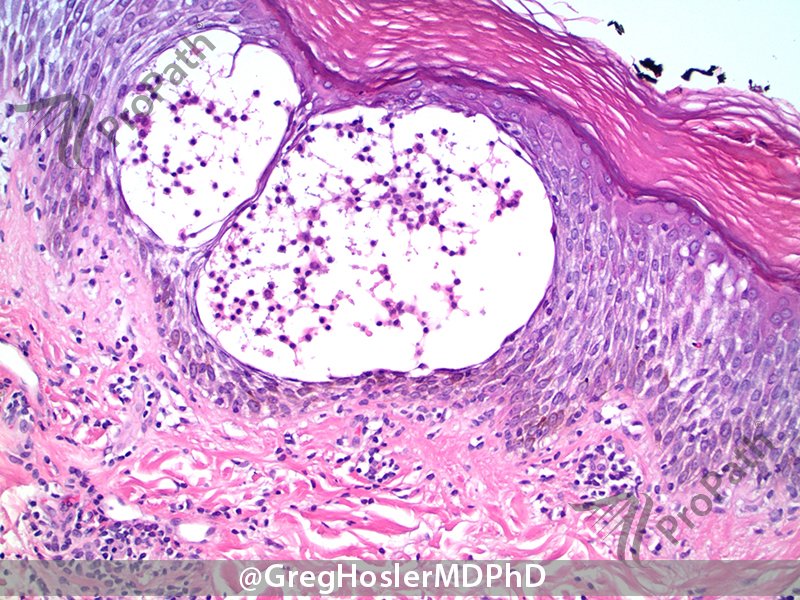 Allergic Contact Dermatitis Histology