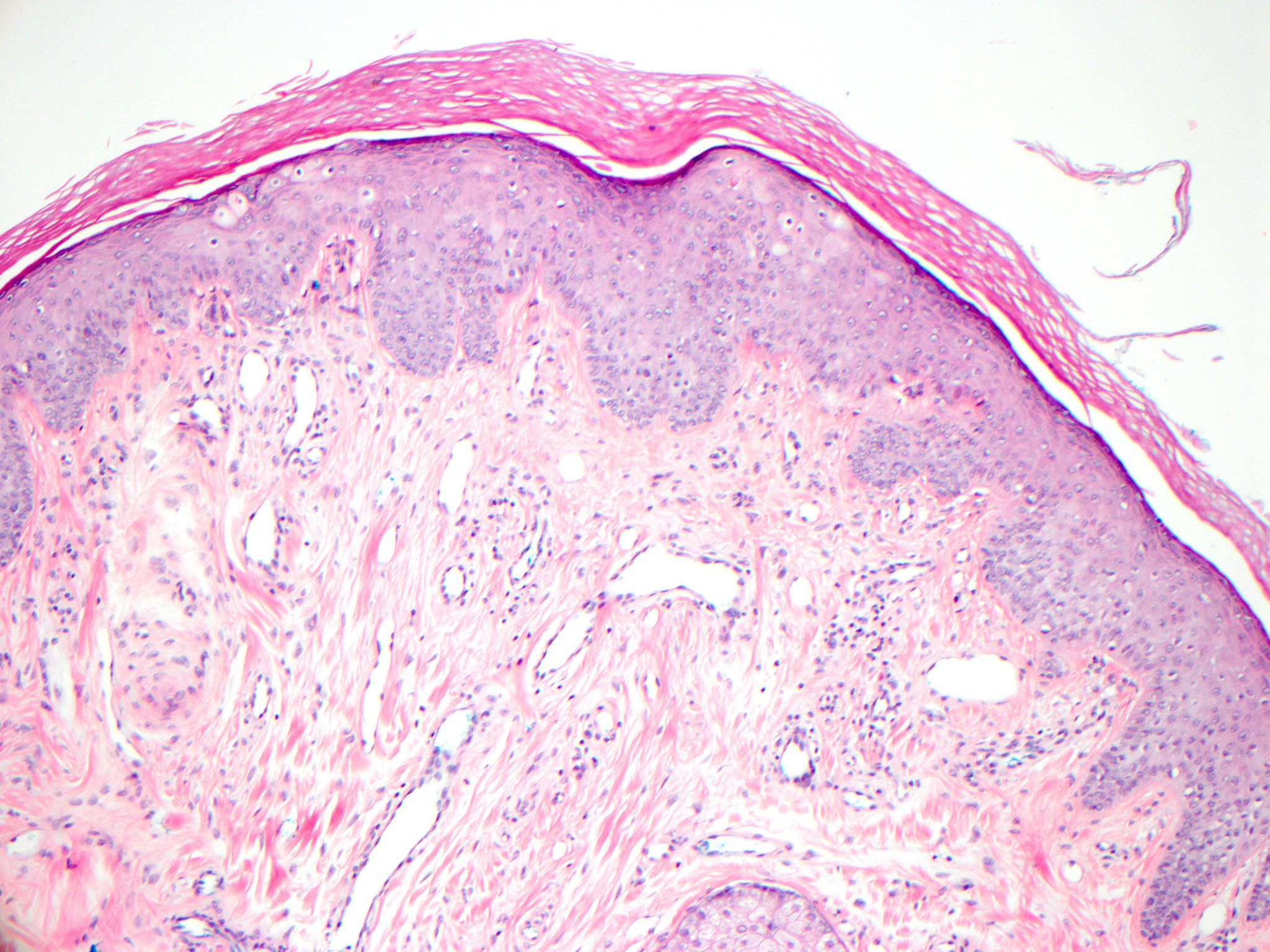 Fibrous Papule Histology