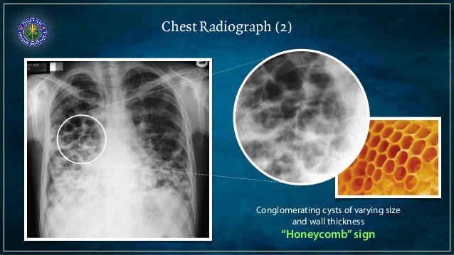 Bronchiectasis X Ray