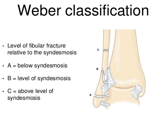 Weber Fracture