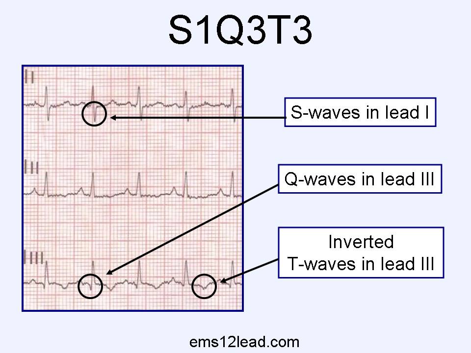 Pulmonary Embolism Ecg
